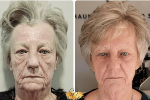 Before & After | Transformative Skin Results NeoGen PSR