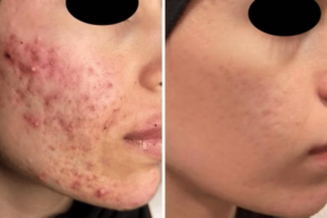 Before & After | Transformative Skin Results NeoGen PSR
