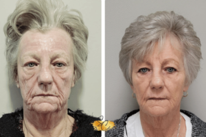 NeoGen PSR | Advanced Skin Treatments | Skin Specialist