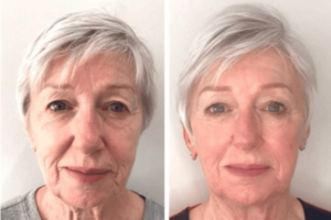 NeoGen PSR | Advanced Skin Treatments | Skin Specialist