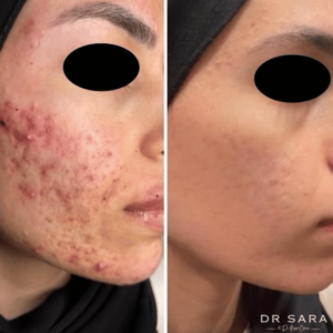 NeoGen PSR | Advanced Skin Treatments | Skin Specialist