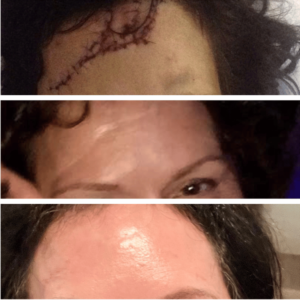 NeoGen PSR | Advanced Skin Treatments | Skin Specialist