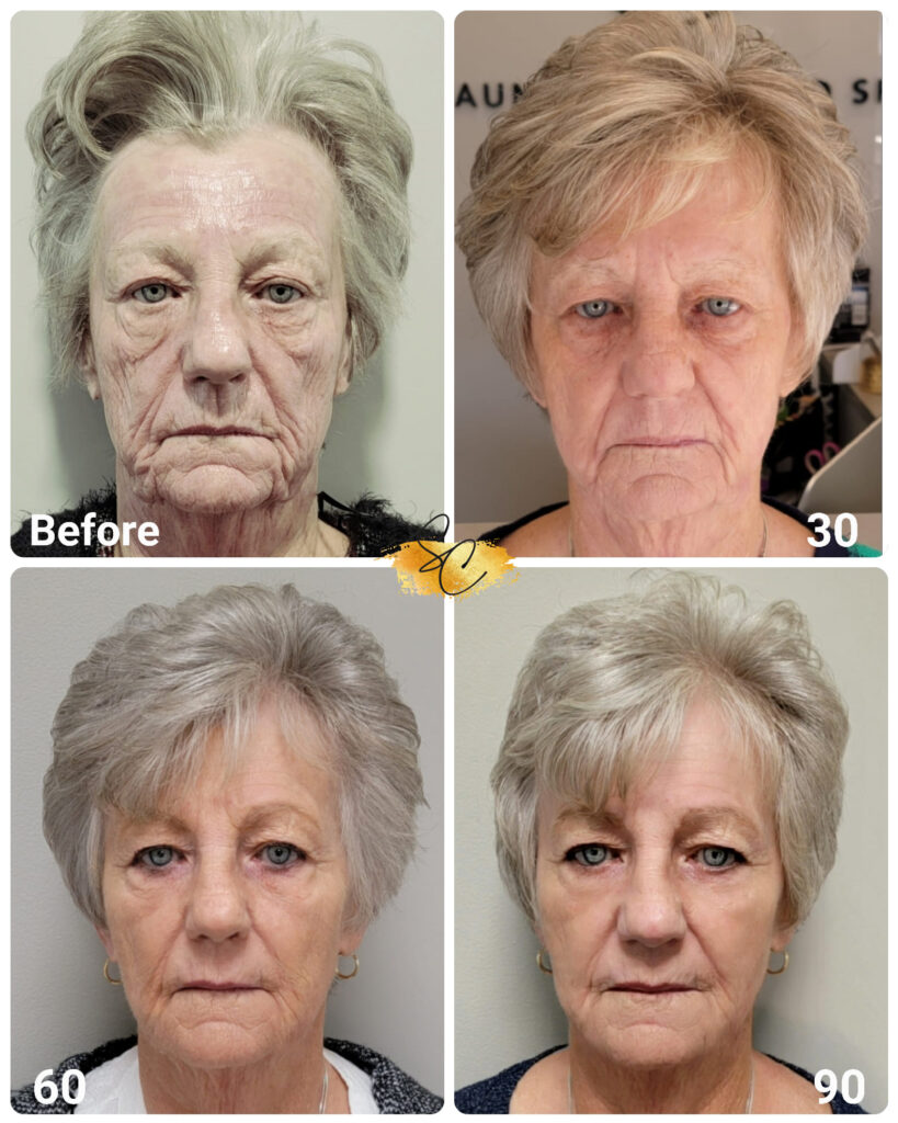 Facial Rhytides | Lines and Wrinkles Treatment | NeoGen PSR