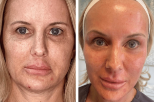 Before & After | Transformative Skin Results NeoGen PSR