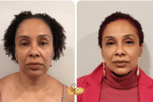 Before & After | Transformative Skin Results NeoGen PSR