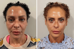 Before & After | Transformative Skin Results NeoGen PSR