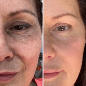 NeoGen PSR | Advanced Skin Treatments | Skin Specialist