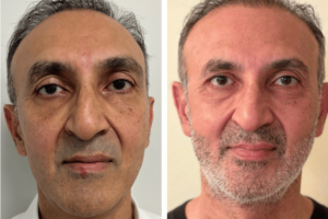 Before & After | Transformative Skin Results NeoGen PSR
